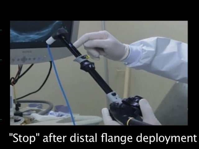 EUS-guided drainage of pancreatic fluid collections on Vimeo
