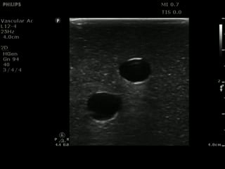 Central Veins - CVC Blue phantom on Vimeo