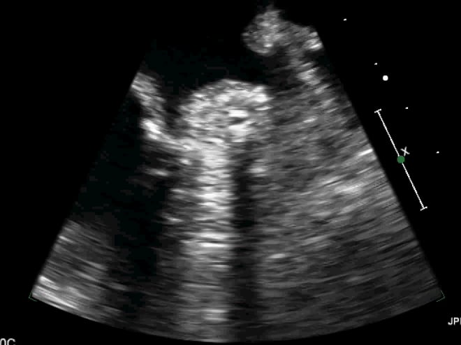 Left atrial appendage showing coumadin ridge on Vimeo