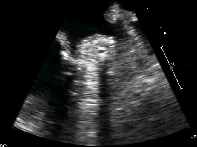 Left atrial appendage showing coumadin ridge on Vimeo