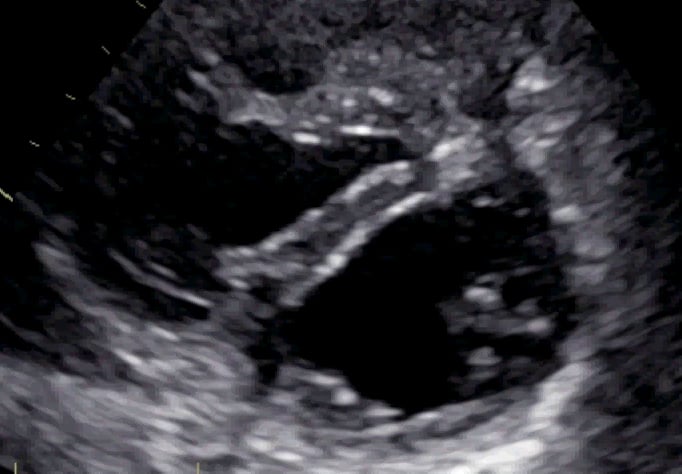 Septal Bowing in Pulmonary Artery Hypertension (Eisenmenger secondary ...