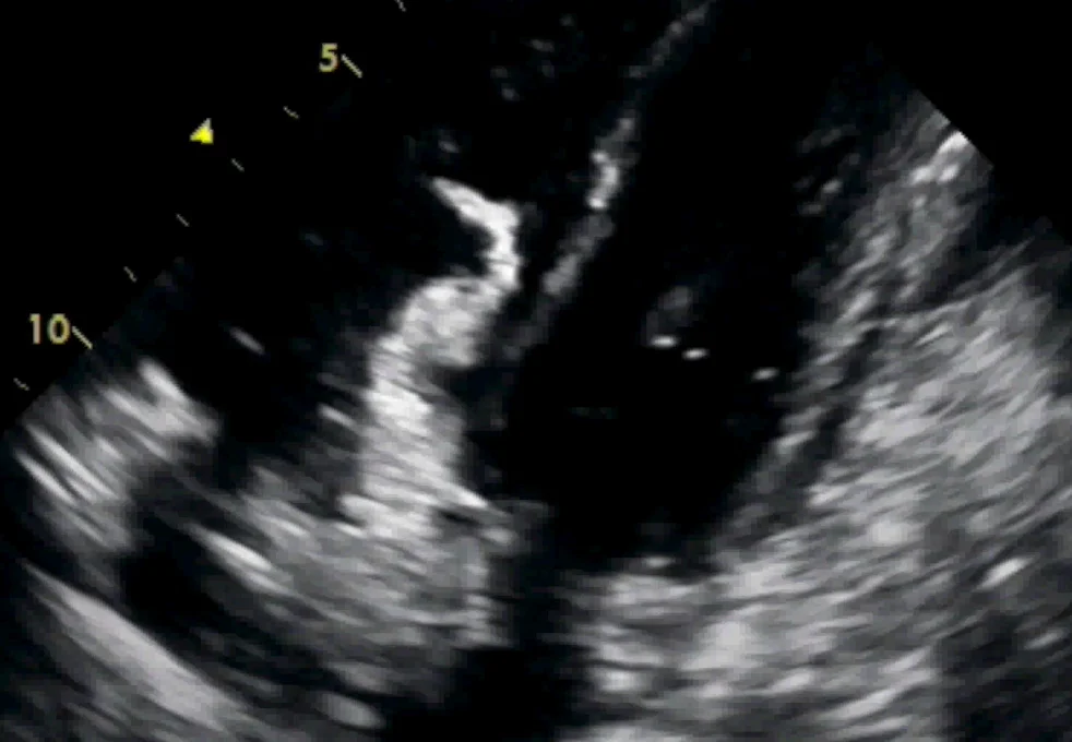 Positive Bubble Study (example)