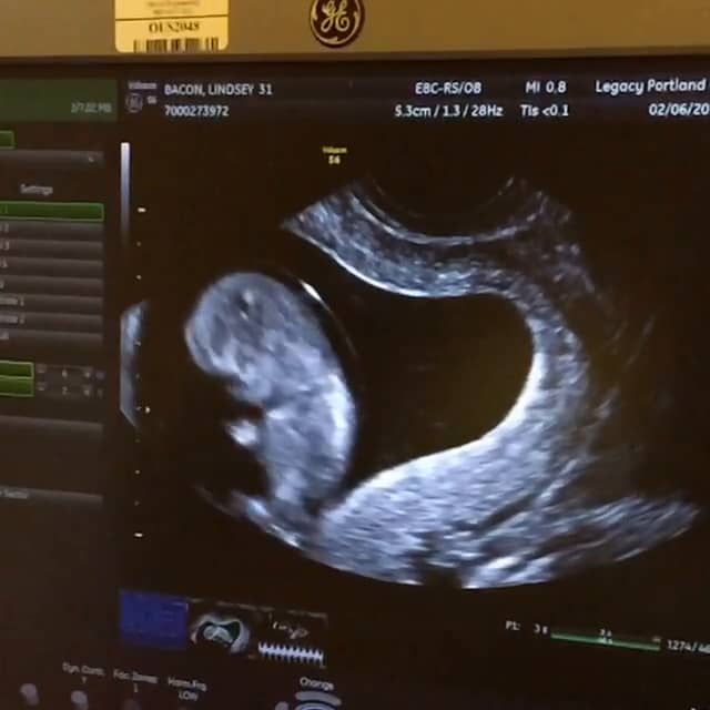 11 weeks ultrasound video on Vimeo