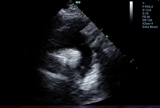 Suprasternal Notch Echo