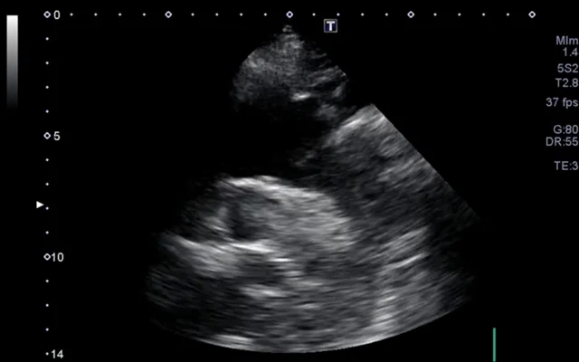 Aortic Dissection Ultrasound