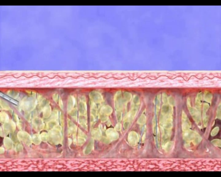 An animation of the VASER Lipo procedure on Vimeo