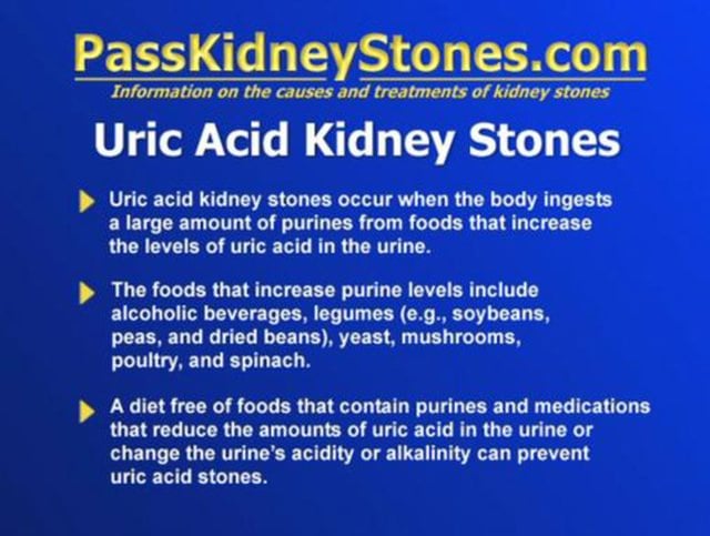 Uric Acid Kidney Stones on Vimeo