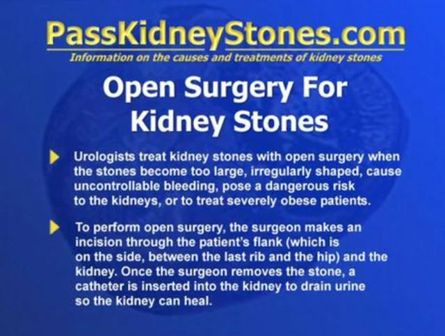 Kidney Stones Open Surgery on Vimeo