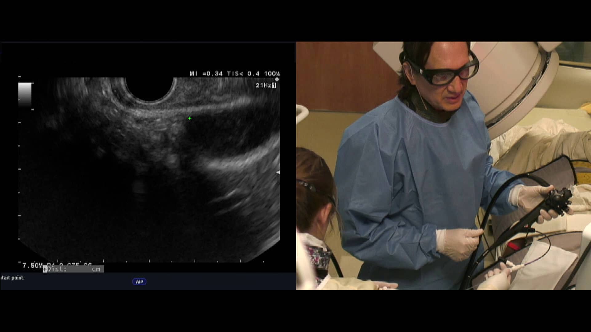 IES-Live: Transduodenal gallbladder drainage (cholecystoduodenostomy ...