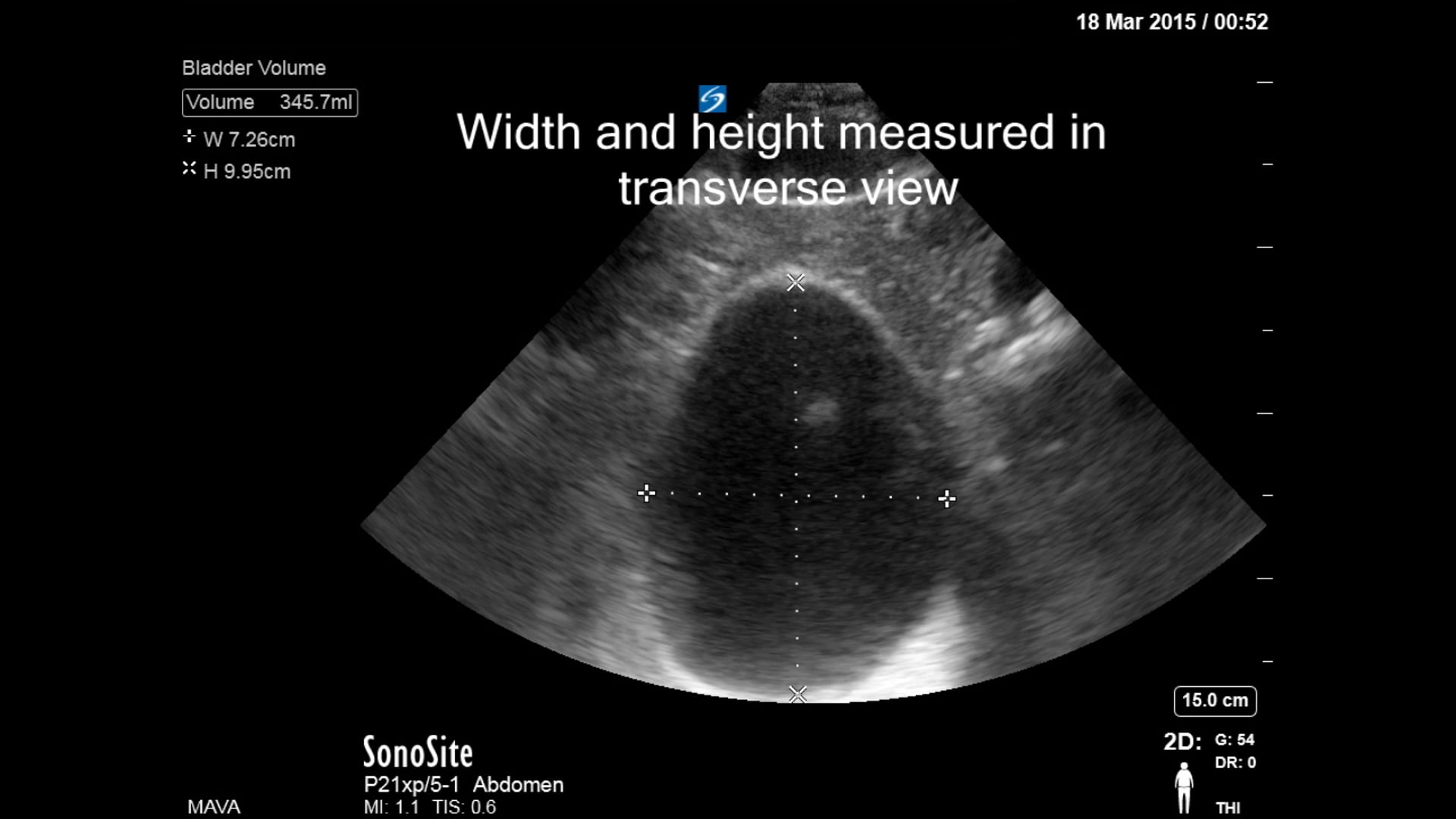 Assessment of bladder volume with ultrasound on Vimeo