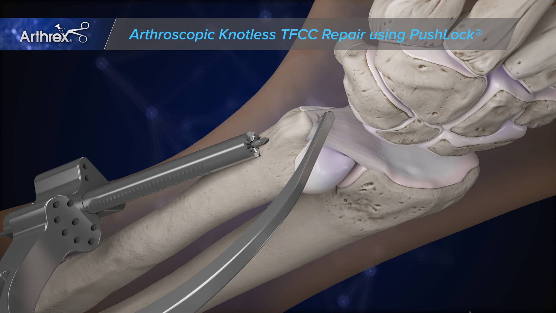 Arthroscopic Knotless TFCC Repair on Vimeo