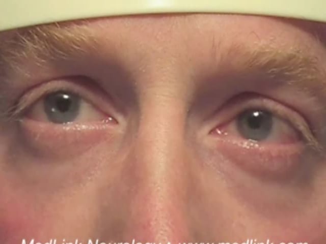 Vertical gaze palsy | MedLink Neurology