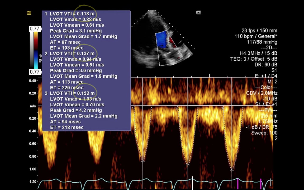 How to use echo to accurately work out the cardiac output (LVOT VTI ...