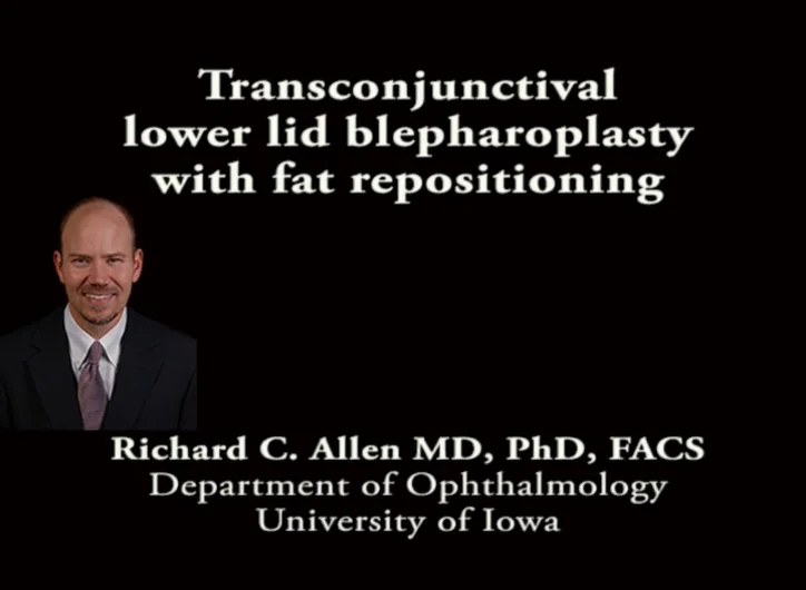 Transconjunctival LL bleph fat reposition