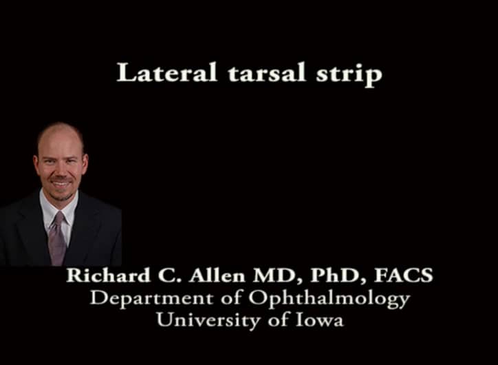 Lateral Tarsal Strip on Vimeo
