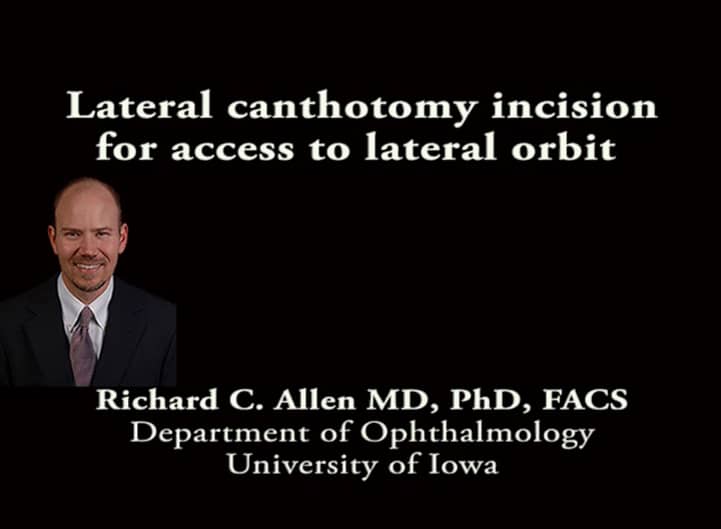 Lateral canthotomy incision for access to lateral orbit on Vimeo
