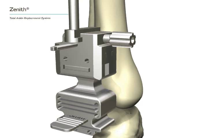 Zenith™ - Surgical Technique on Vimeo