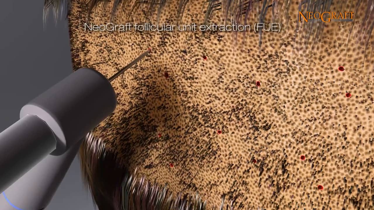 NeoGraft Hair Transplant System Explained | Follicular Unit Extraction ...