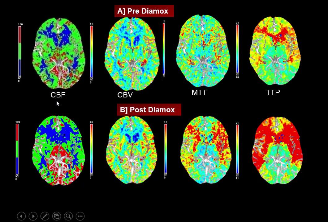 Neurocurriculum Live: CT Perfusion with Diamox Challenge on Vimeo