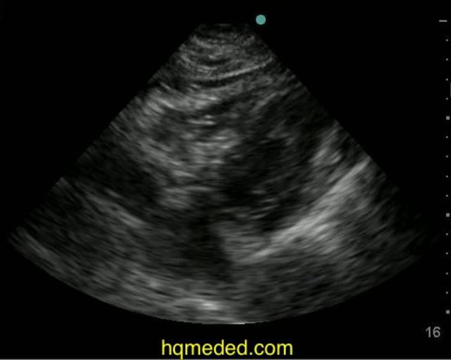 Ultrasonography - cardiac arrest, standstill on Vimeo