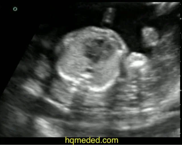 20 week IUP on Vimeo