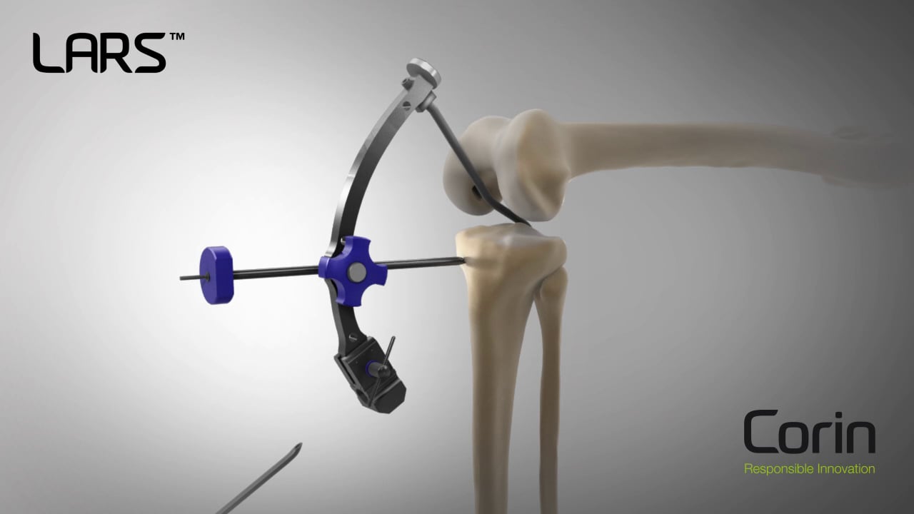 LARS/CORIN Group - Knee PCL repair on Vimeo