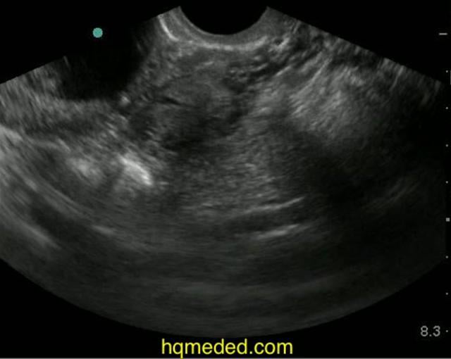 Ultrasonography - complex ovarian cyst on Vimeo