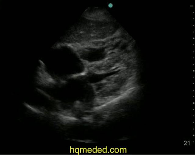 Ultrasonography - global hypokinesis, dilated cardiomyopathy on Vimeo