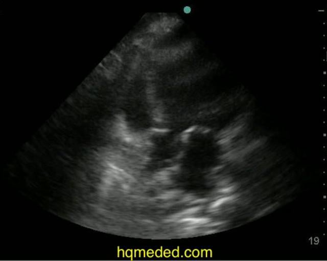 Ultrasonography - echo, IVC on Vimeo