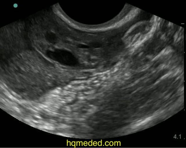 Ultrasonography - ectopic pregnancy on Vimeo