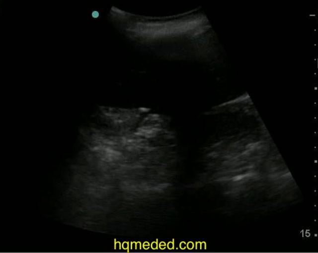 Ultrasonography - positive FAST on Vimeo
