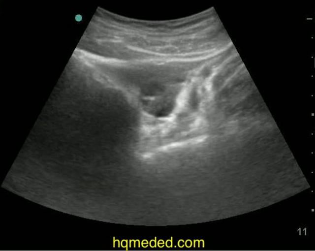 Ultrasonography - positive FAST on Vimeo