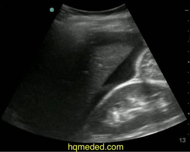 Ultrasonography - positive FAST on Vimeo