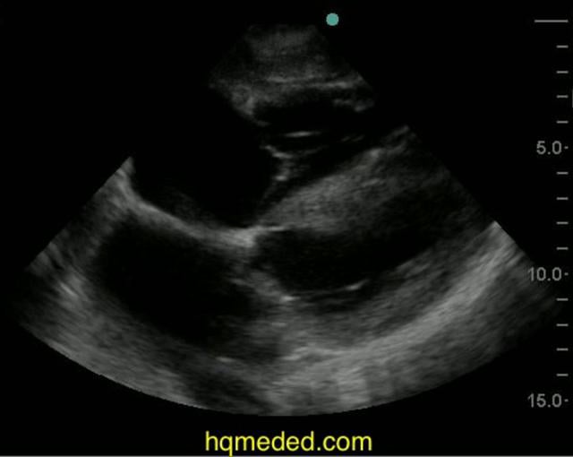 Ultrasonography - global hypokinesis, dilated cardiomyopathy on Vimeo