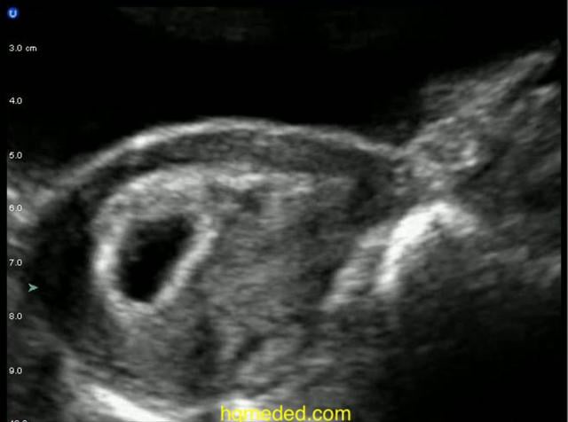 Ultrasonography - IUP early on Vimeo