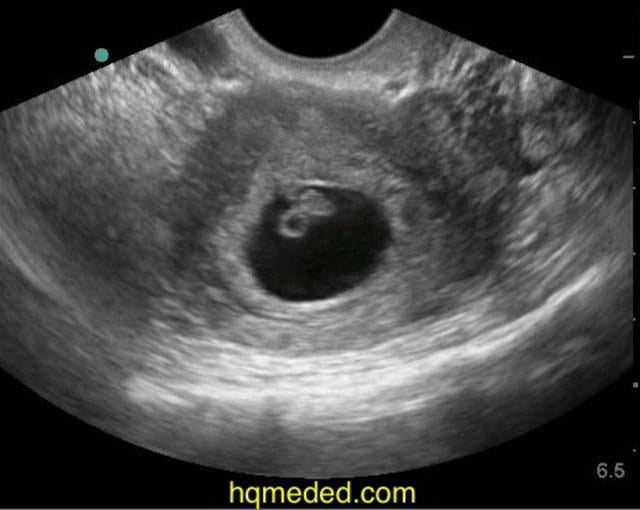 Ultrasonography - IUP early on Vimeo