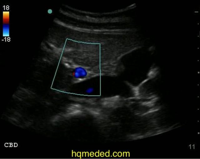Ultrasonography - normal gallbladder on Vimeo