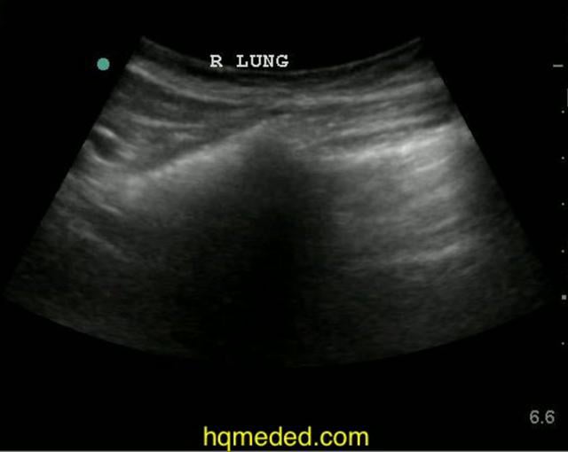 Ultrasonography - normal sliding signs on Vimeo