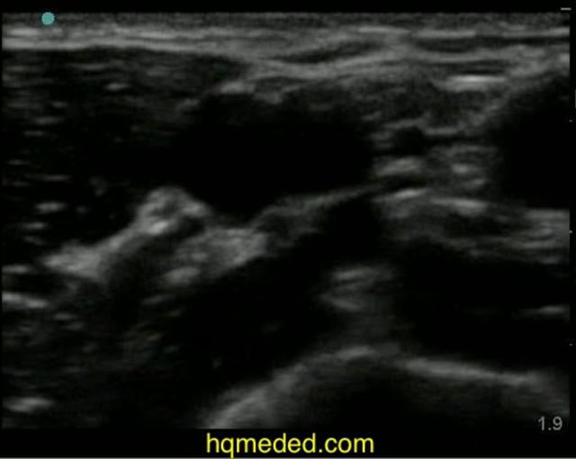 Ultrasonography - peripheral IV on Vimeo