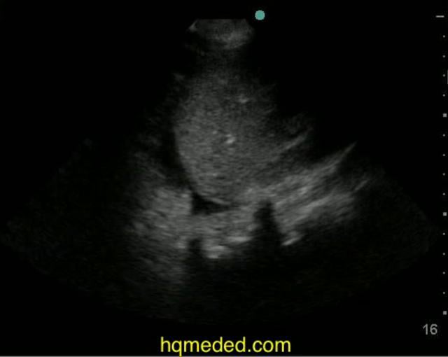 Ultrasonography - pleural effusion, GSW right chest on Vimeo