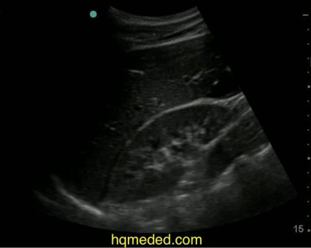 Ultrasonography - positive FAST on Vimeo