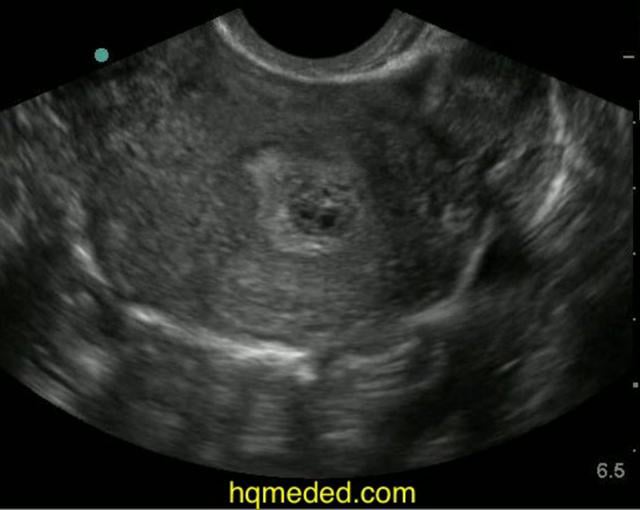 Ultrasonography - possible twin vs subchorionic hemorrhage on Vimeo