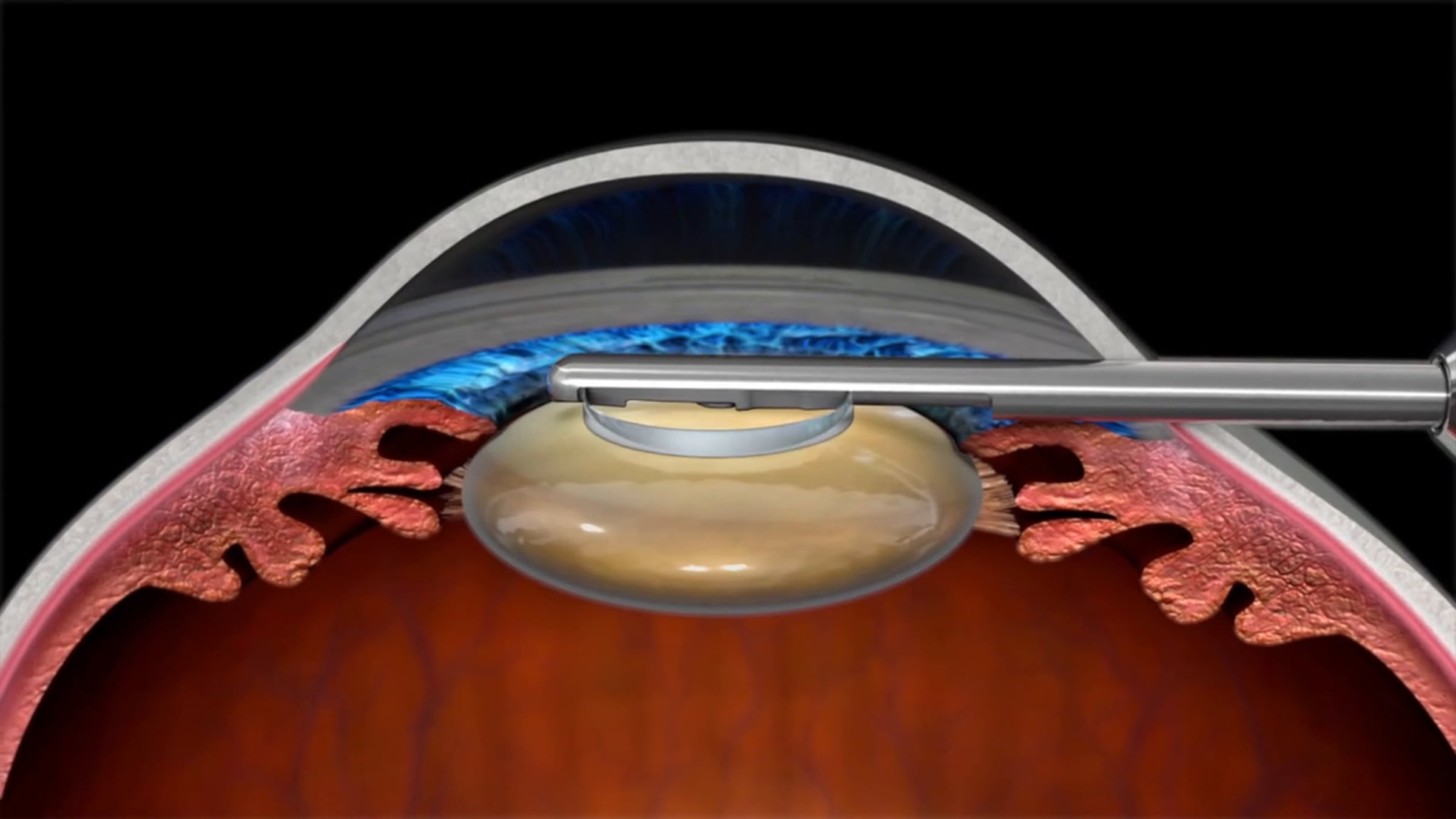 ApertureCTC™ Continuous Thermal Capsulotomy™ System