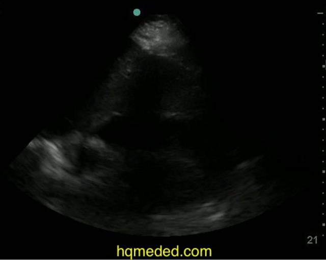 Ultrasonography - early tamponade on Vimeo