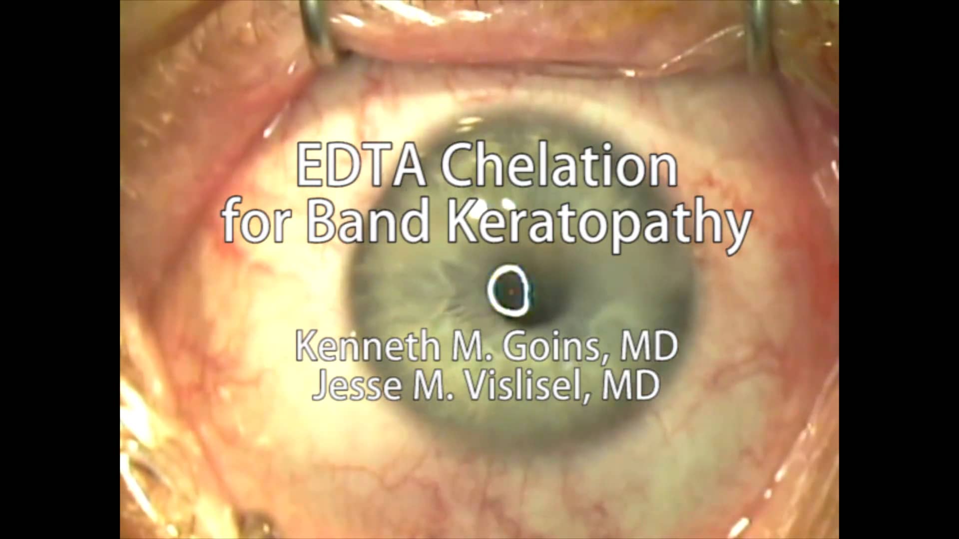 EDTA Chelation for band keratopathy on Vimeo