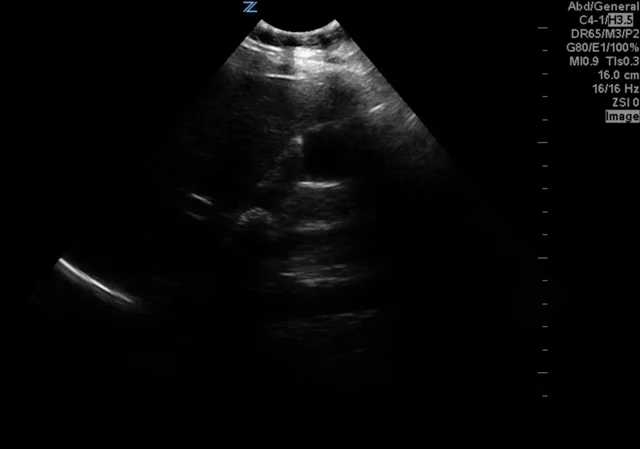 Strawberry Gallbladder Ultrasound