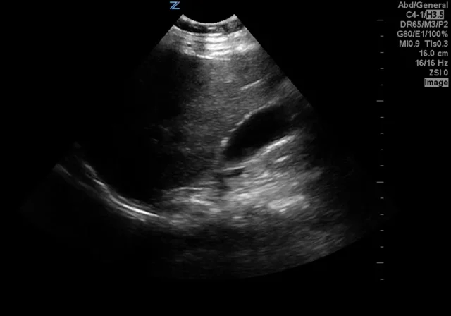 Cholesterolosis Ultrasound