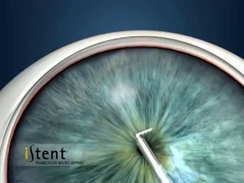 iStent Animation Video Dan Lindfield Consultant Ophthalmologist ...