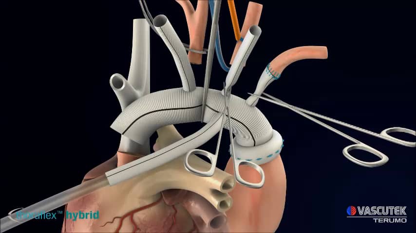 Thoraflex hybrid Vascomed medical on Vimeo