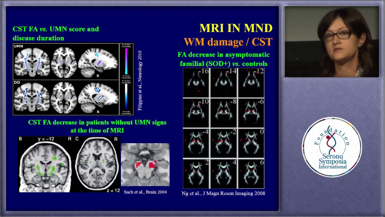 MND spectrum: MRI features - F. Agosta (Italy) on Vimeo